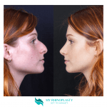 14 Tipi Di Naso: Scopri Il Tuo E Come Correggerlo • My Rhinoplasty