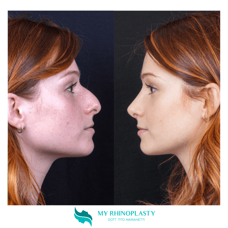 14 Tipi Di Naso: Scopri Il Tuo E Come Correggerlo • My Rhinoplasty