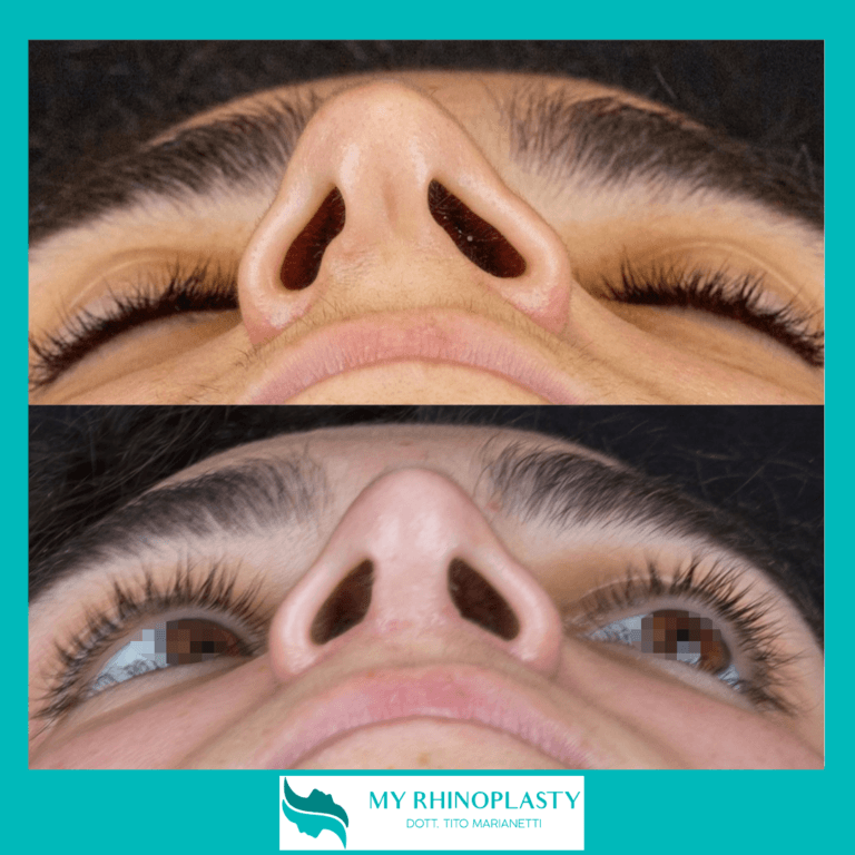 Settoplastica: Cose Da Sapere Sull’intervento Di Correzione Del Setto ...