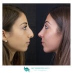 14 Tipi Di Naso: Scopri Il Tuo E Come Correggerlo • My Rhinoplasty