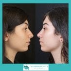 14 Tipi Di Naso: Scopri Il Tuo E Come Correggerlo • My Rhinoplasty