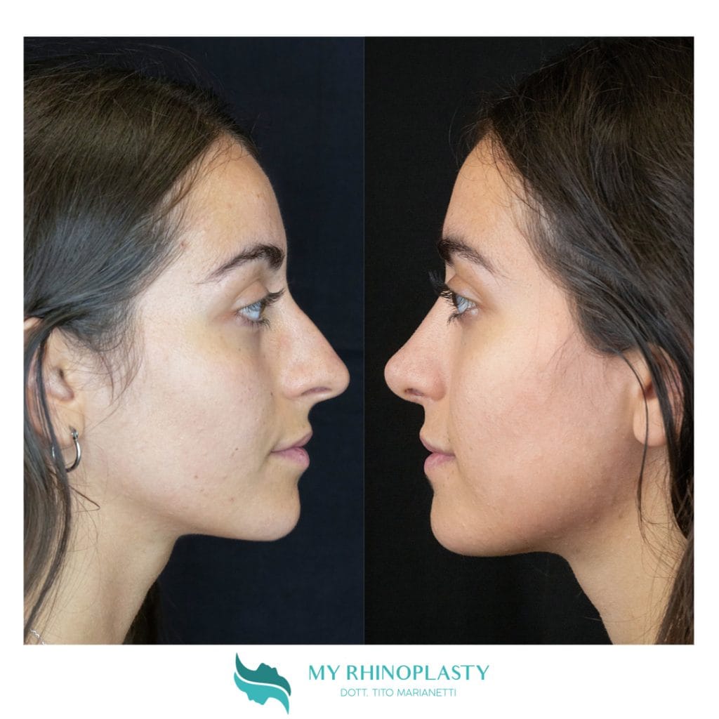 Rifarsi Il Naso: Il Periodo Migliore Per La Rinoplastica • My Rhinoplasty