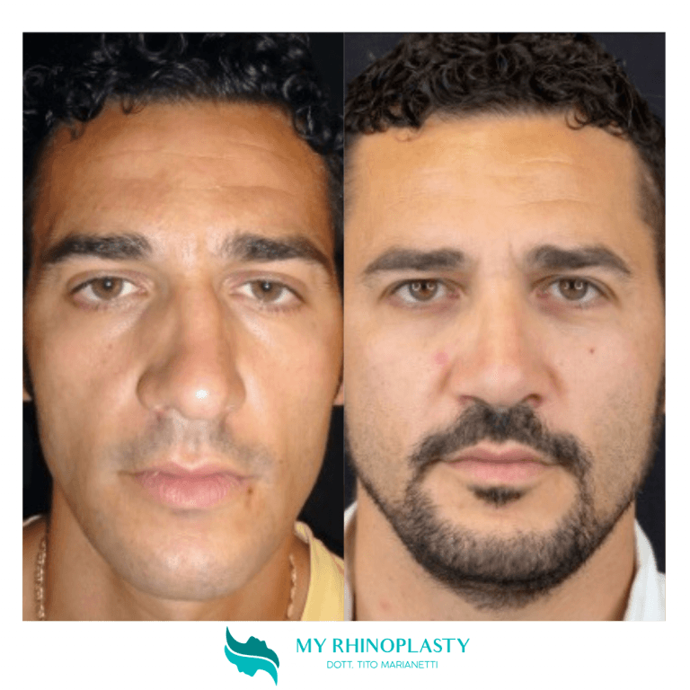 Come Stappare Il Naso: Rimedi Efficaci Per Respirare Meglio • My ...