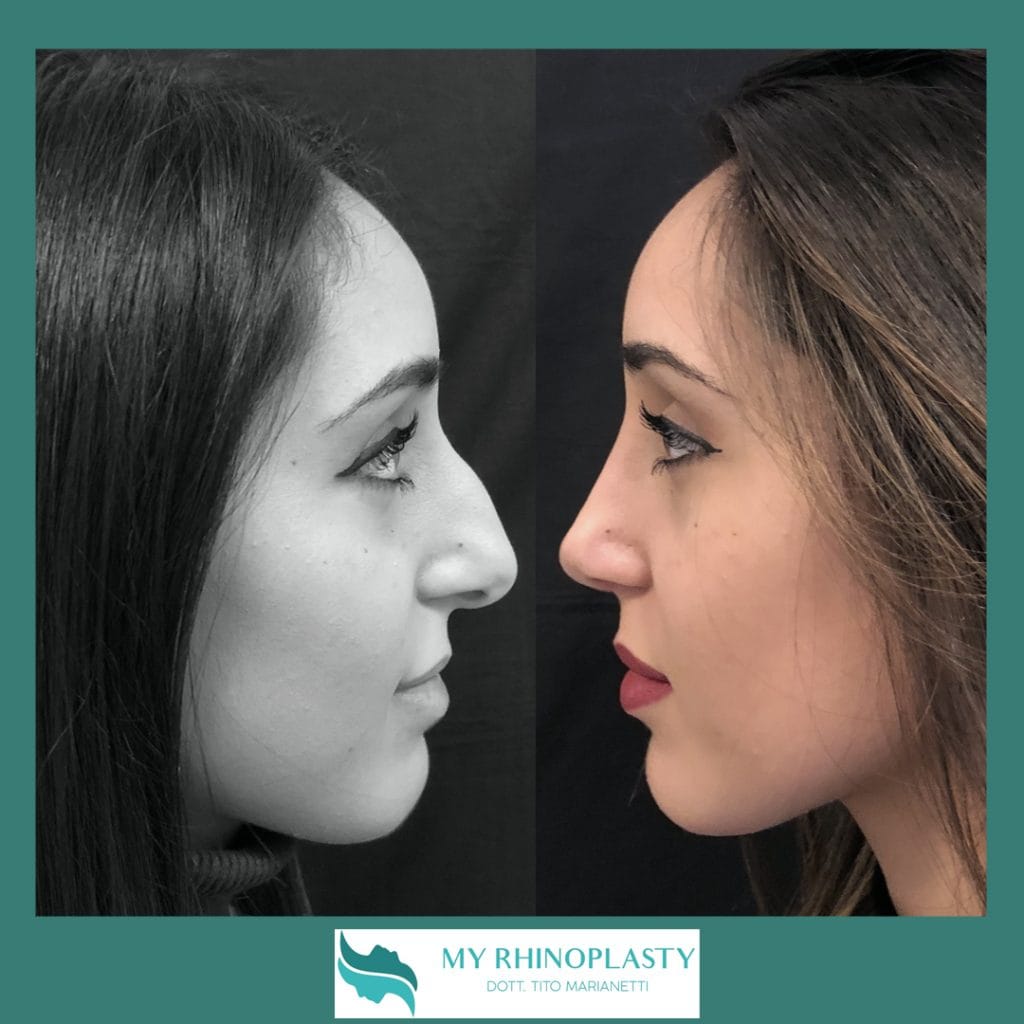 Operazione Rinoplastica: I 7 Rischi Da Considerare • My Rhinoplasty