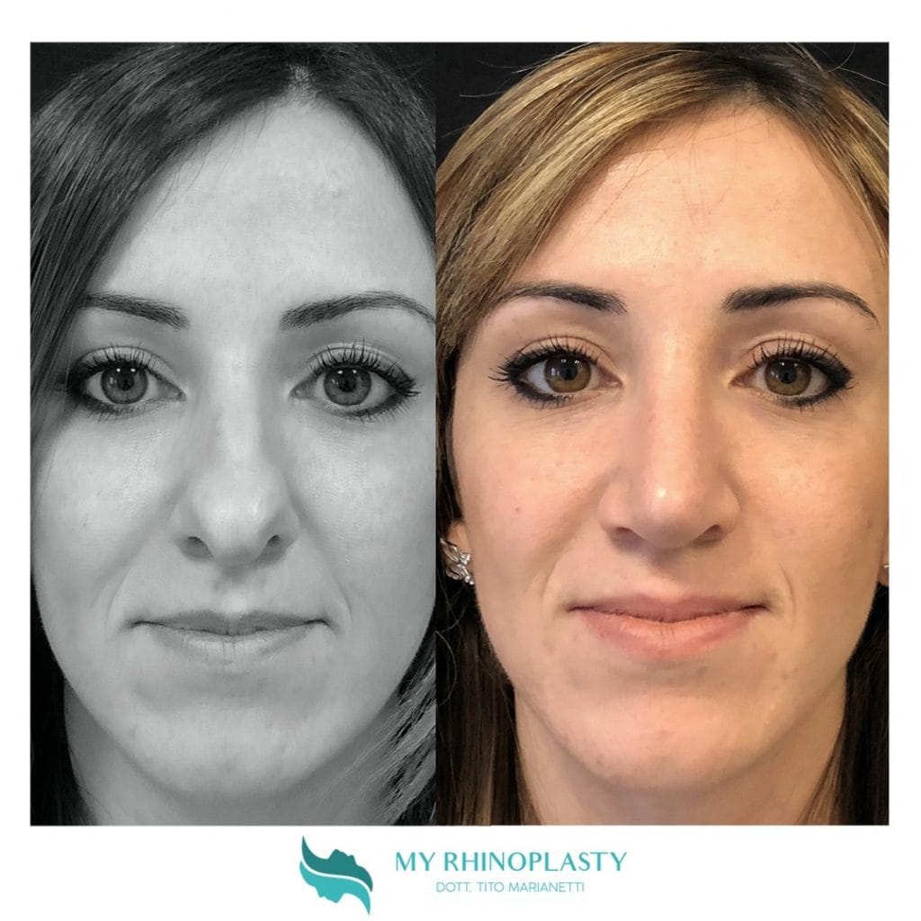 Rinoplastica Punta Naso: Scopri L'intervento • My Rhinoplasty