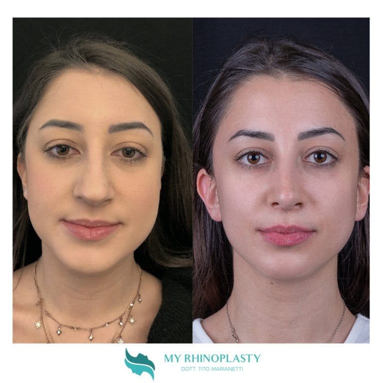Rinoplastica Punta Naso: Scopri L'intervento • My Rhinoplasty