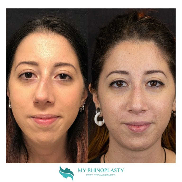 Operazione Setto Nasale Deviato: Tutto Quello Che Devi Sapere • My ...