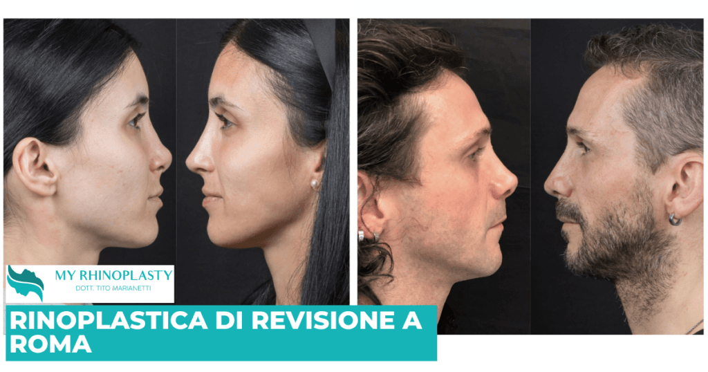 Rinoplastica Di Revisione Roma: Cosa Sapere • My Rhinoplasty