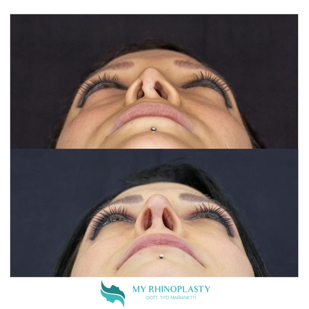 Tutto Sul Naso: Anatomia, Funzione E Patologie • My Rhinoplasty