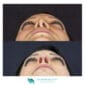 Anatomia Del Naso: Scopriamo Le Sue Funzioni • My Rhinoplasty