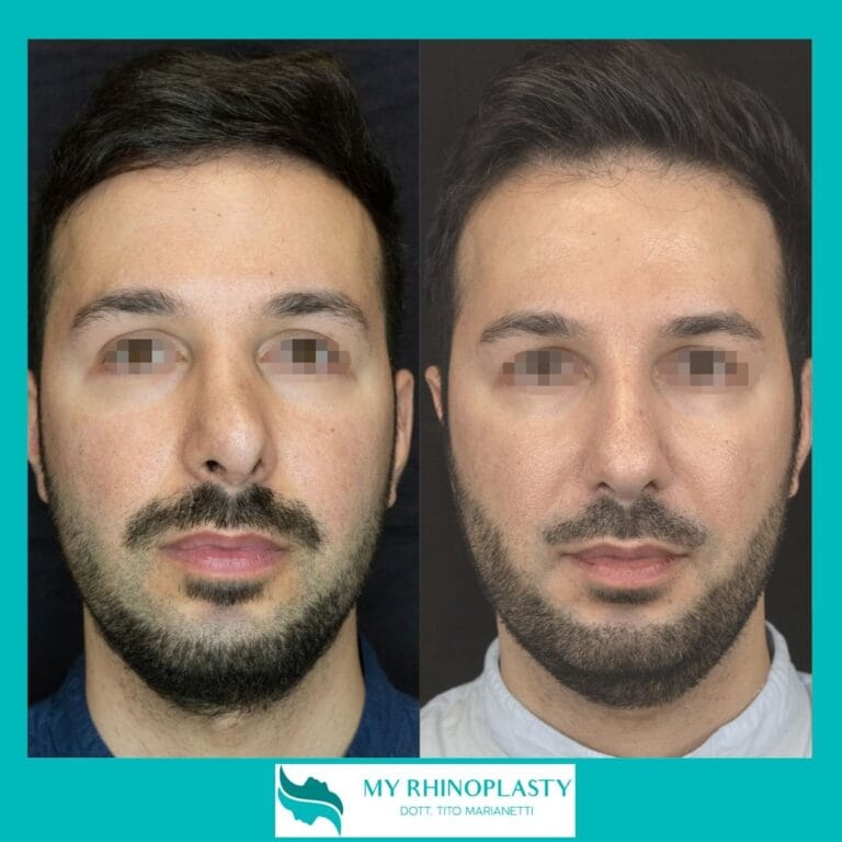 Turbinati Naso: Cause, Sintomi E Opzioni Di Cura